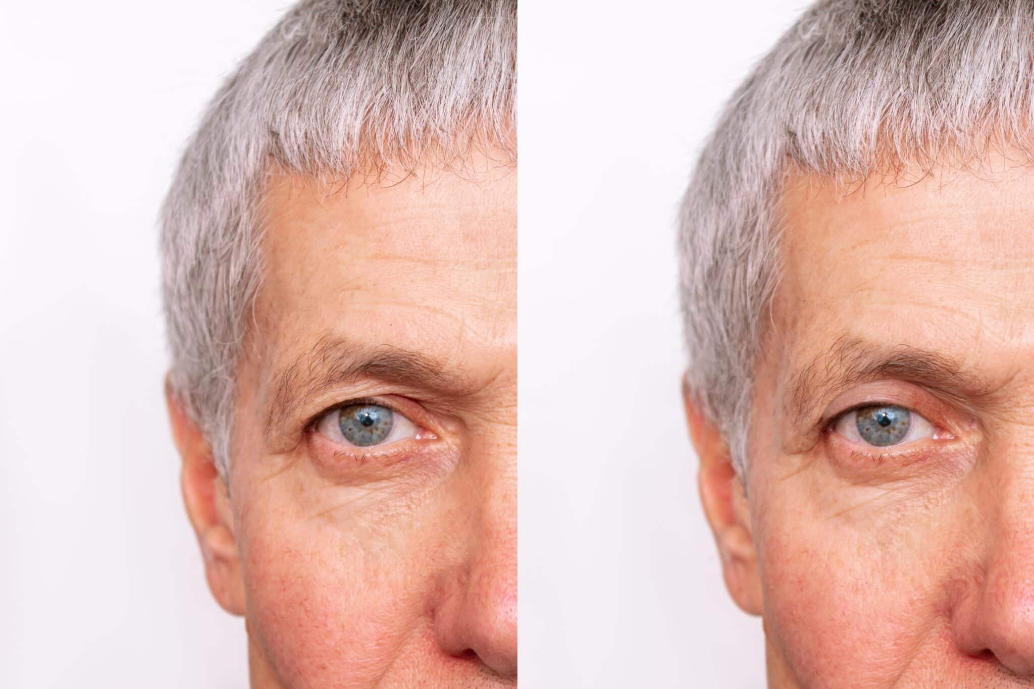 Blepharoplasty St. Augustine | Eyelid Surgery Palatka